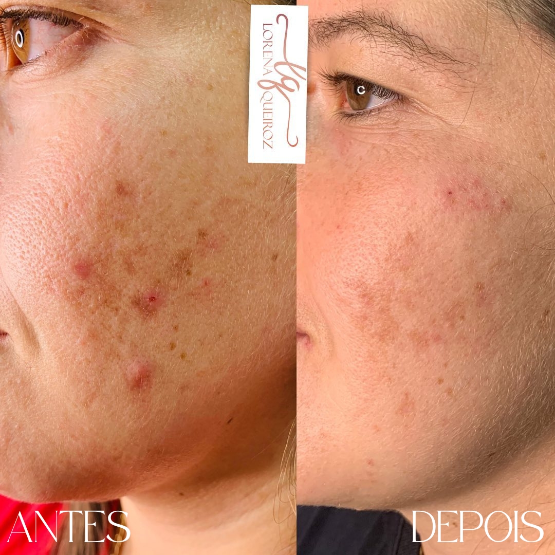 Tratamento de Acne - Dra. Lorena Queiroz